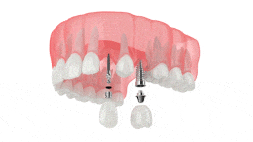 Are Mini Implants As Good As Regular Implants Implant Dentist
