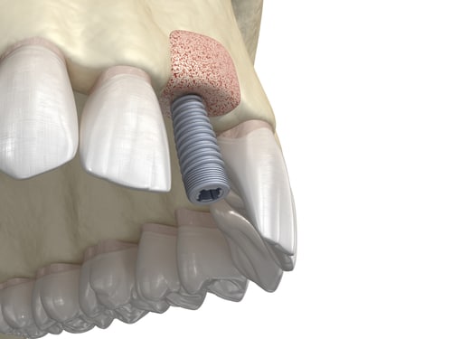 Bone Grafting Alternatives | Mini Dental Implants in Ontario, CA
