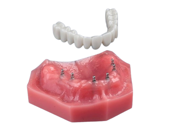 Fix-on-Six in Ontario, CA | Mini Dental Implants | Implant Dentures